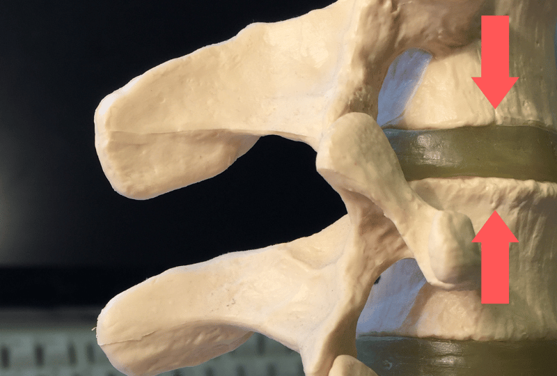 Treat Mild Disc Space Narrowing at Home - Spinal Backrack